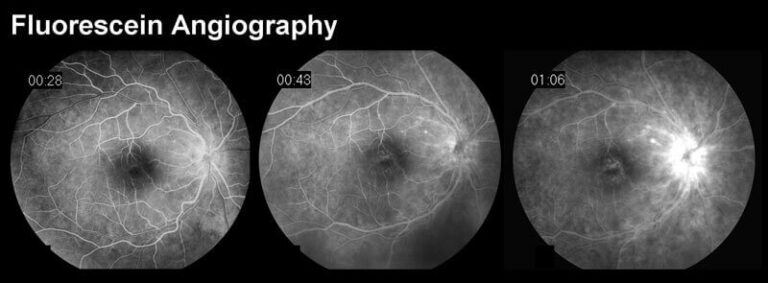 Choroidal Neovascular Membranes Boston | Glaucoma Falmouth